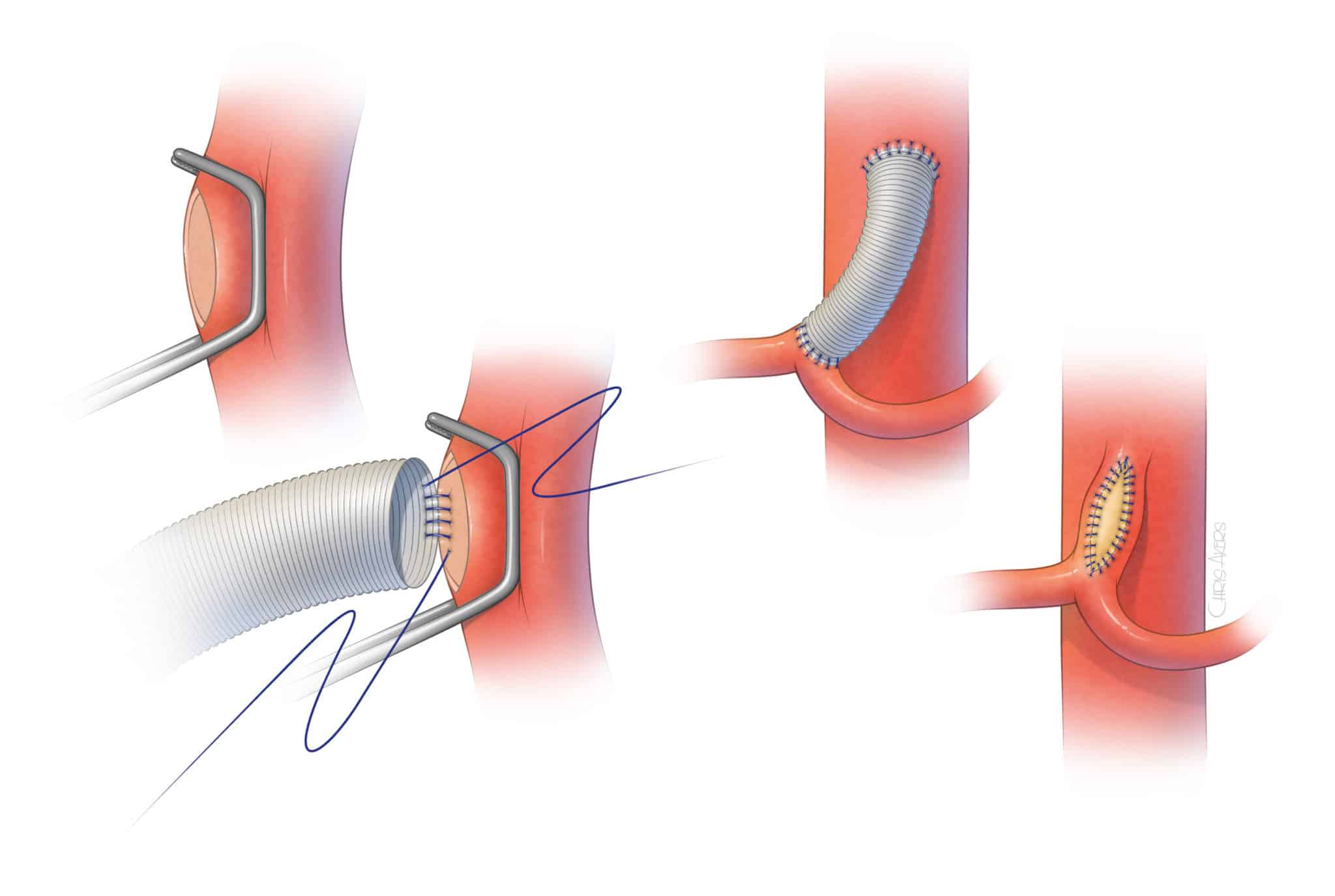 UT Physicians | Median arcuate ligament syndrome (MALS)