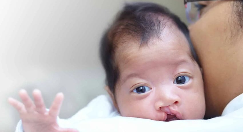 Comprehensive Cleft and Craniofacial Care - UT Physicians