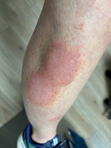 Understanding Adult-onset Eczema | UT Physicians