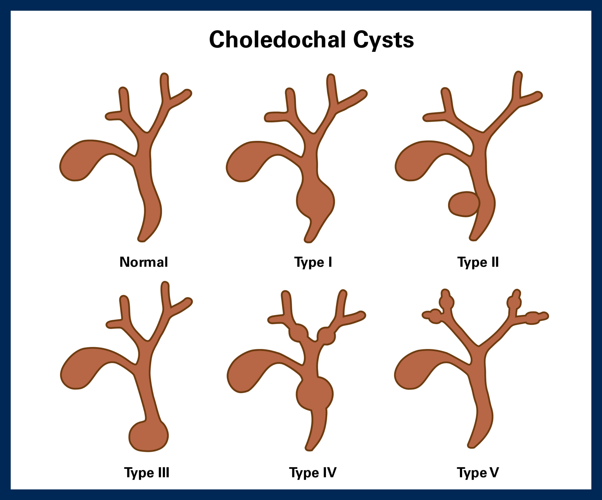 Pediatric choledochal cyst | Pediatric surgery | UT Physicians